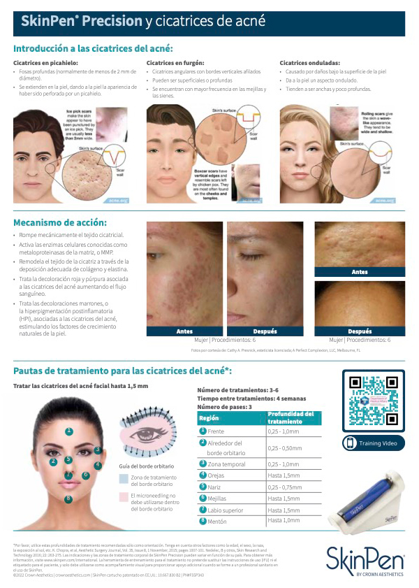 SkinPen Precision y Cicatrices de Acné - Real Lasting
