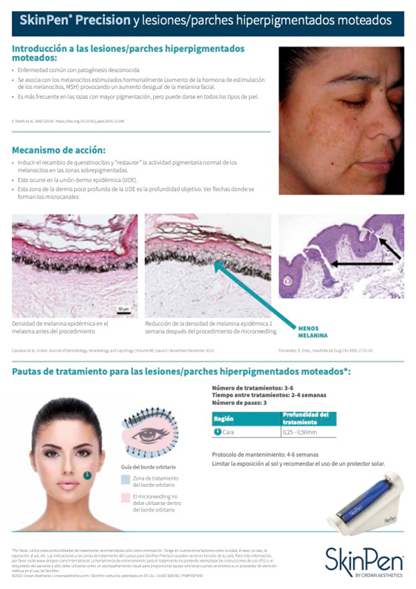 SkinPen Precision y Lesiones/Parches Hiperpigmentados Moteados - Real ...